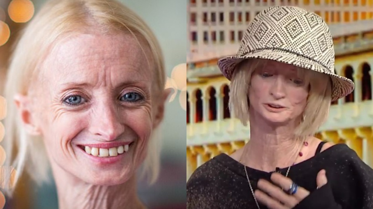 46-year-old woman ages eight times faster than usual over rare ... 46-year-old woman ages eight times faster than usual over rare ...